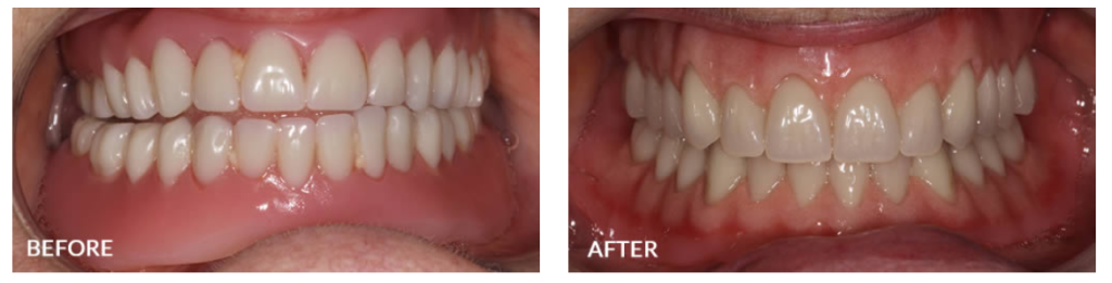 Complete Denture - Milton Dental Clinic